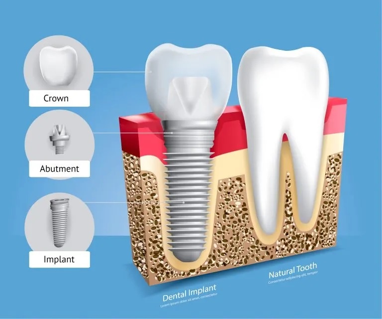 Dental Implants in Cibolo - implantsincibolo